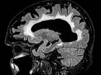 White Matter Hyperintensity and Vascular Disease from Biological Basis to Clinical Significance